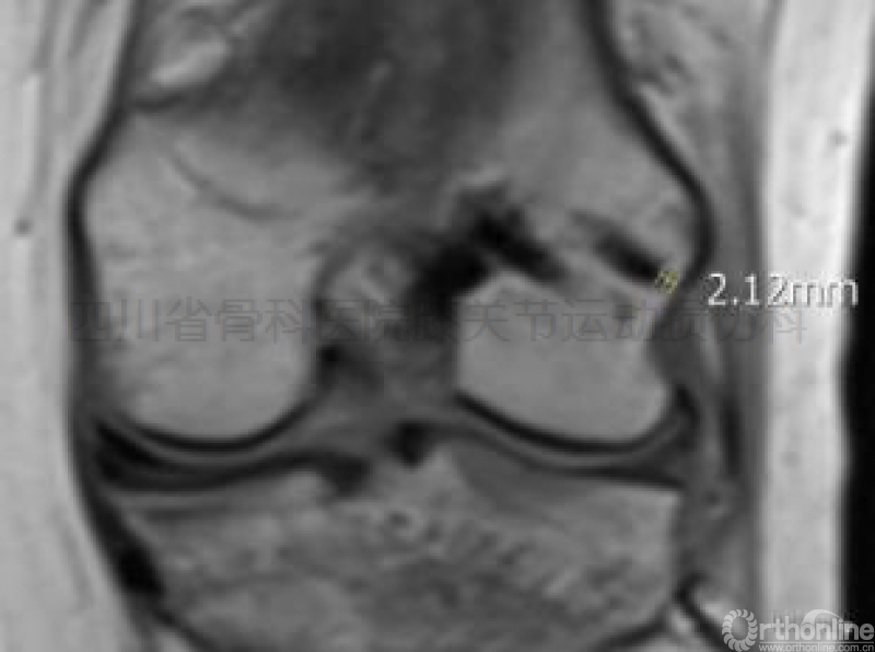 前交叉韧带股骨隧道RigidFix固定技术：保留还是放弃？ | 学术园地