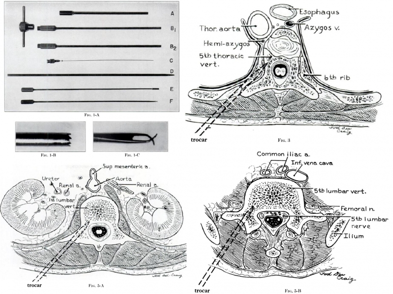 从“脊髓镜”谈到UBE/BESS：追溯脊柱内镜演化史（上） | 学术园地