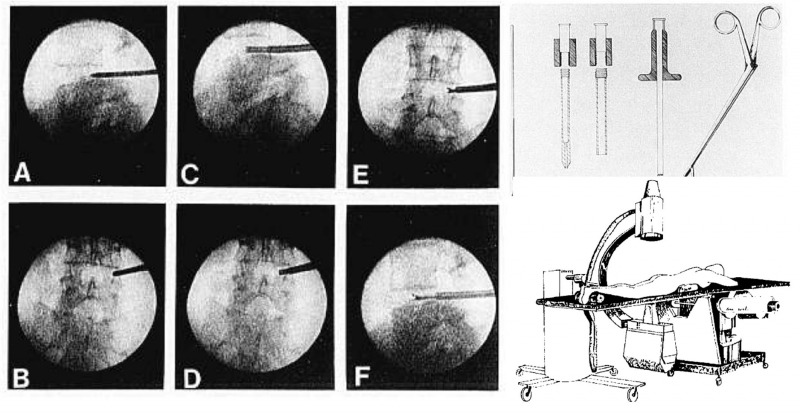 从“脊髓镜”谈到UBE/BESS：追溯脊柱内镜演化史（上） | 学术园地
