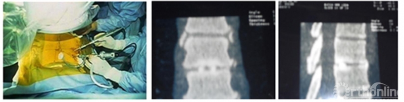 从“脊髓镜”谈到UBE/BESS：追溯脊柱内镜演化史（上） | 学术园地